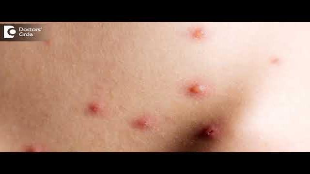 Boutons sur les seins : Causes, traitements et prévention